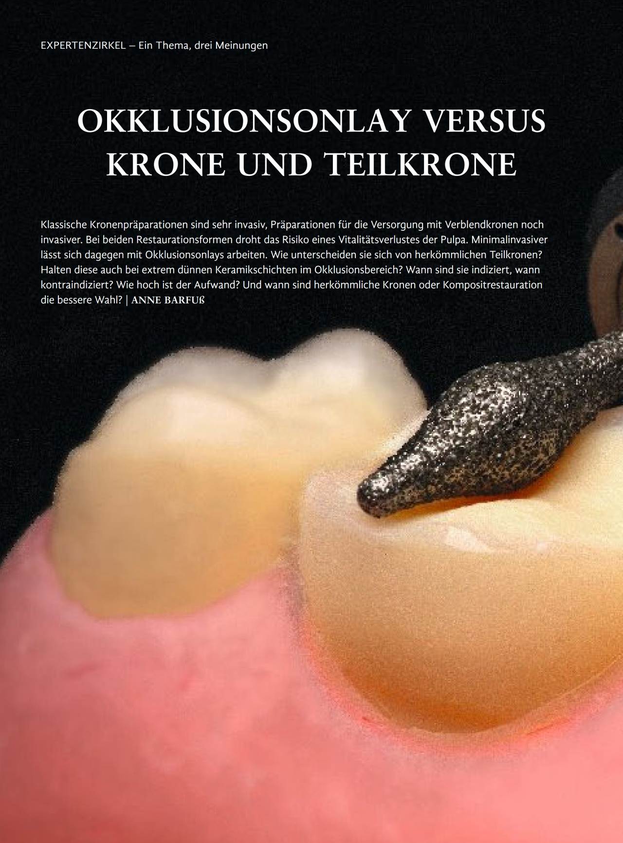 FB | Okklusionsonlay versus Krone und Teilkrone › Komet Magazin