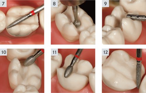 Die wichtigsten Regeln für Keramikinlays und -Teilkronen › Komet Magazin